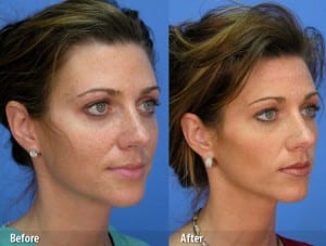 MicroLaserPeel® by Sciton® | Skin Rejuventation | Reno, NV | Dr. Louis ...