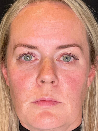 Injectables Archives - Bonaldi Aesthetics Plastic Surgery & Med Spa