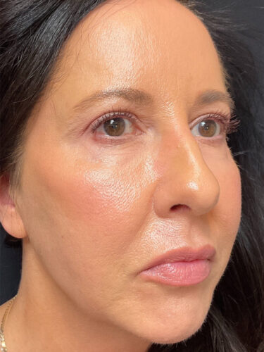 Injectables Archives - Page 2 of 5 - Bonaldi Aesthetics Plastic Surgery ...