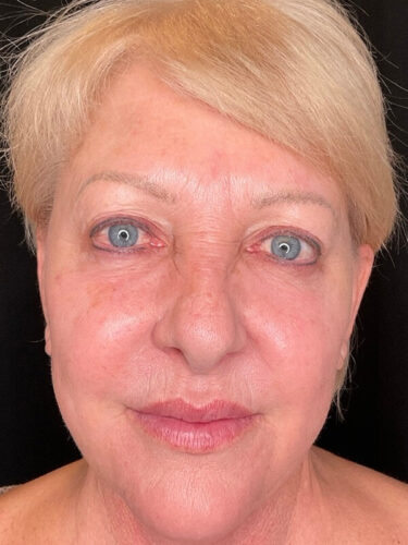 Before and After Injectables - Bonaldi Aesthetics Plastic Surgery & Med Spa