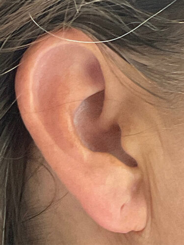 Before and After Injectables - Bonaldi Aesthetics Plastic Surgery & Med Spa